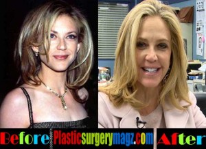 Ally Walker Plastic Surgery Before and After - Plastic Surgery Magazine
