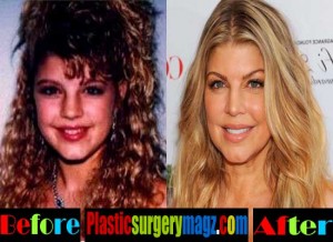 Fergie Plastic Surgery Before and After - Plastic Surgery Magazine