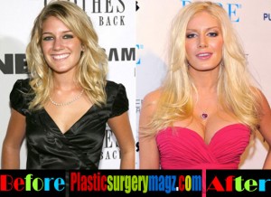 Heidi Montag Plastic Surgery | Back Scoop Surgery Before And After ...