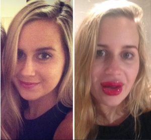 8 Bad Plastic Surgery Duck Lips Pics - Plastic Surgery Magazine