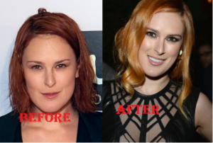 Rumer Willis Plastic Surgery - Plastic Surgery Magazine